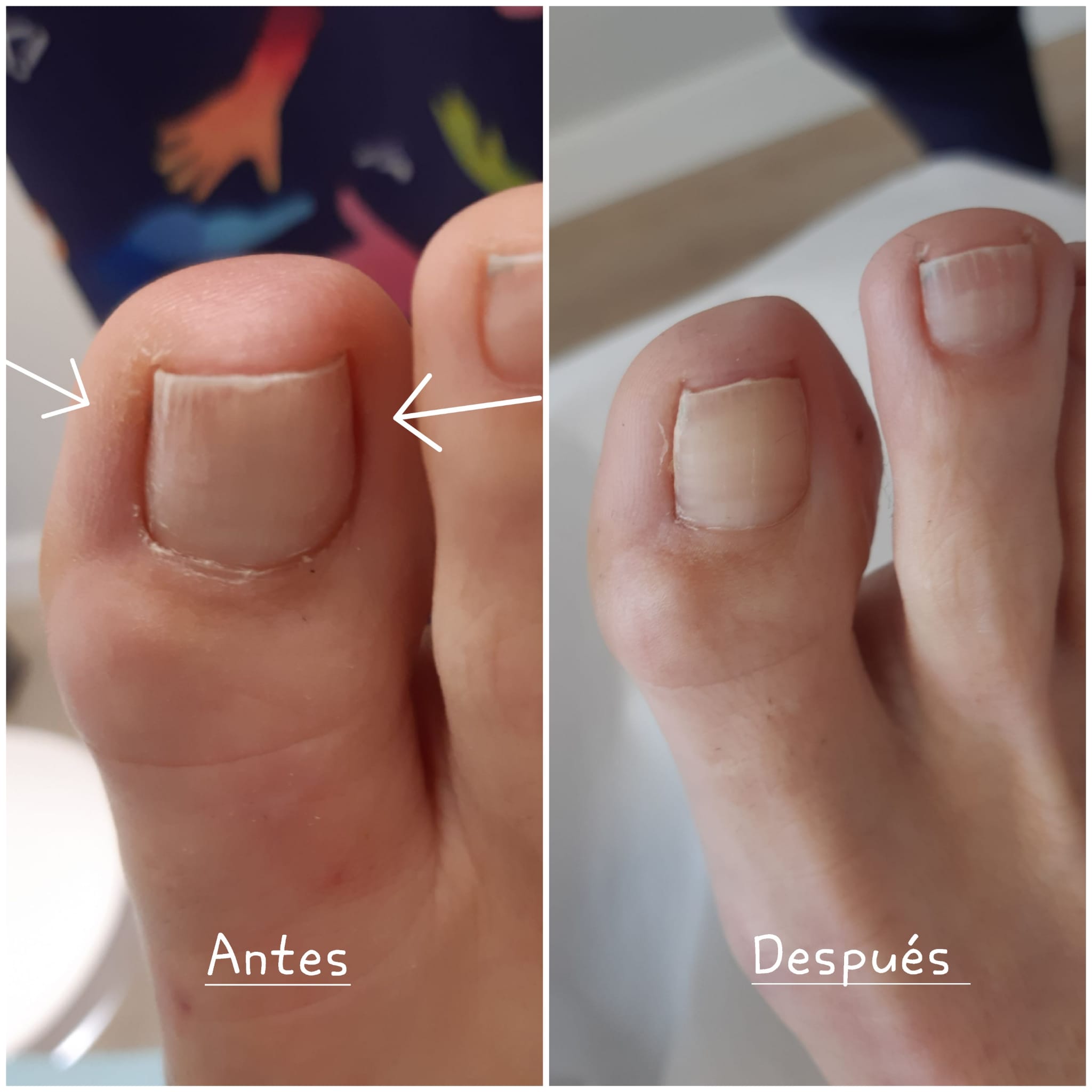 Uña encarnada u Onicocriptosis – Clínica Ferrer Salud